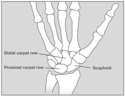 Scaphoid Fractures | Raymond Severt, M.D.